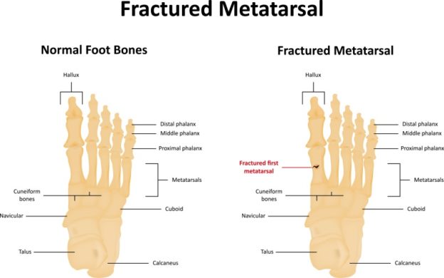 Metatarsal Fractures: Causes, Symptoms, Diagnosis and Treatment Tips ...